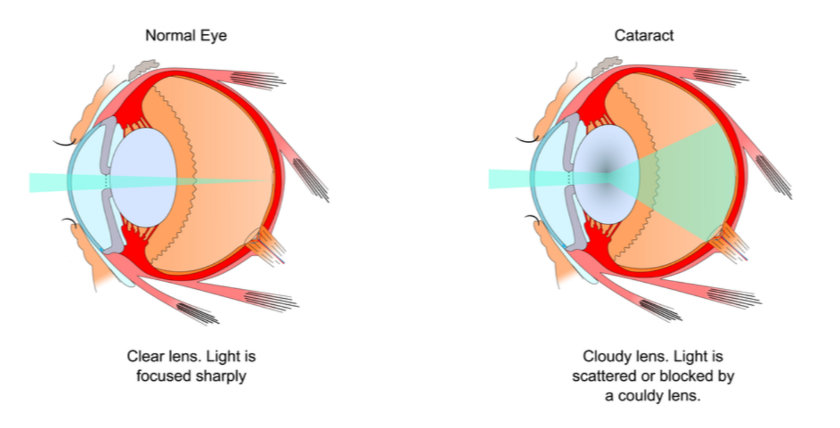 Cataracts: Prevention and Treatment | Visioncare Optometry